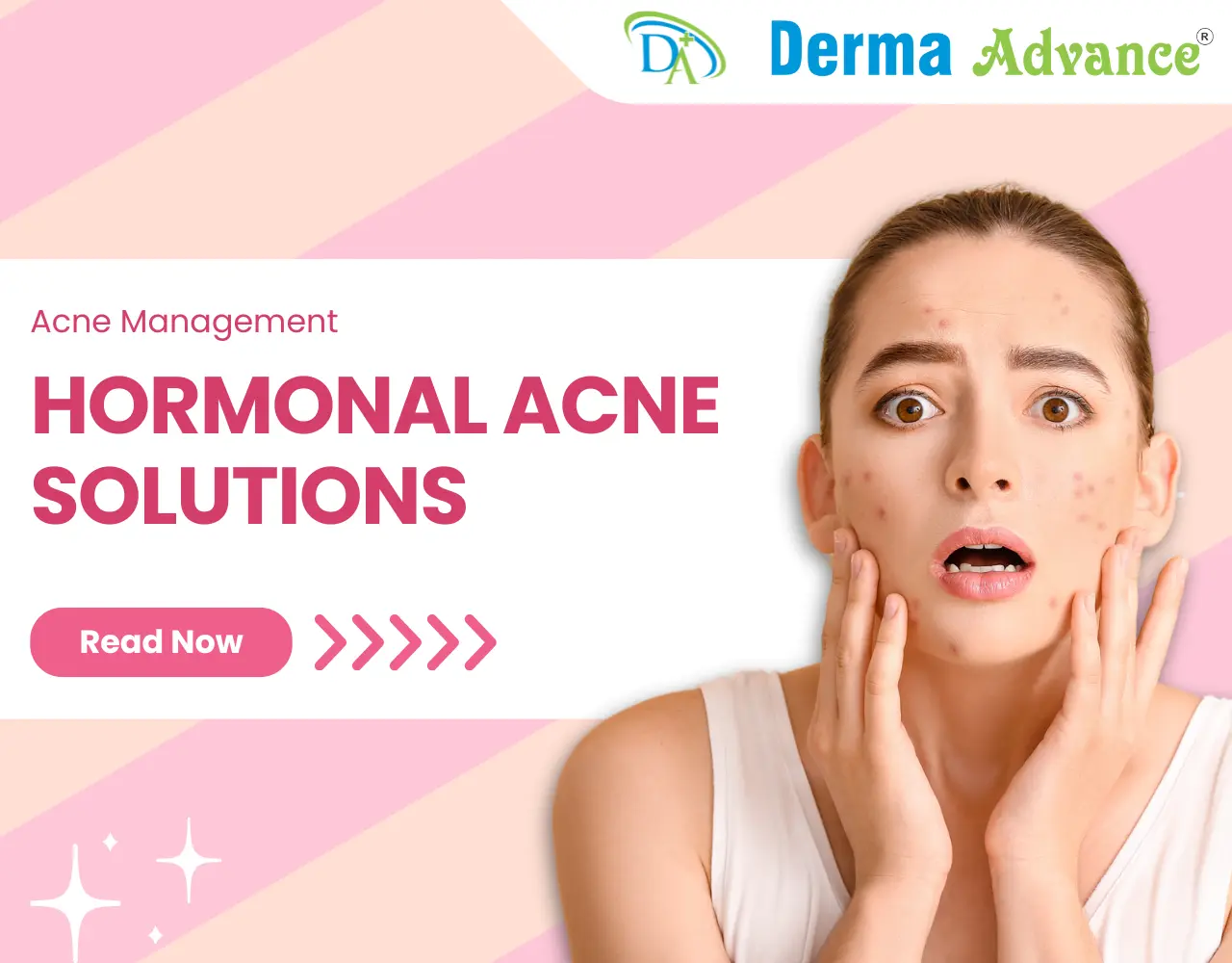 Hormonal Acne Solutions - Derma Advance