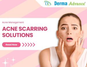 Acne Scarring Solutions: Types, Causes, Effective Treatments