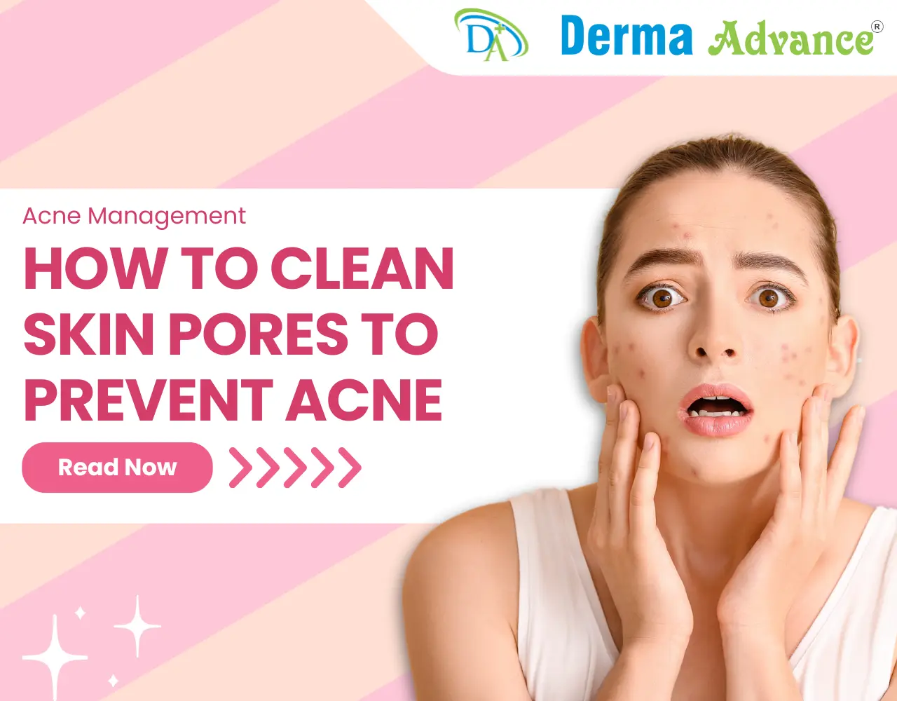 How to clean Skin Pores to Prevent Acne - Derma Advance