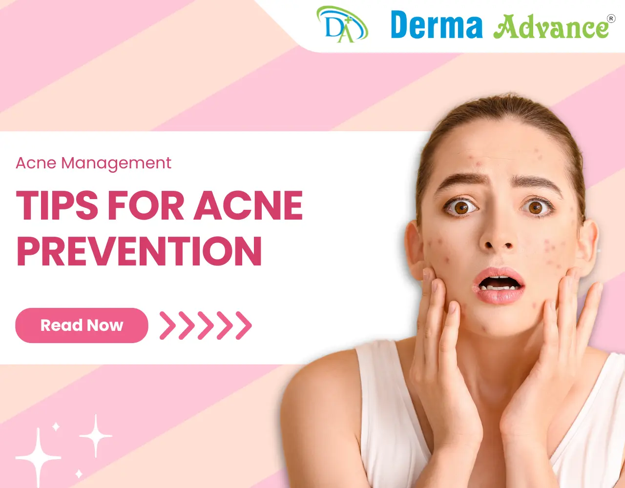 Tips for Acne Prevention - Derma Advance