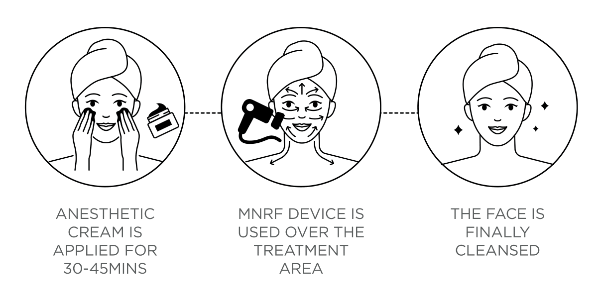 MNRF: The Complete Guide to Micro needling with RF