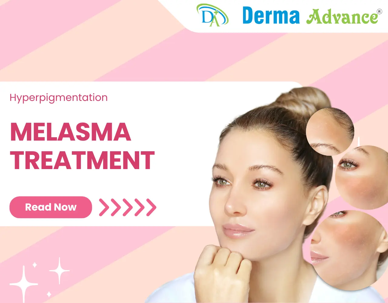 Melasma Treatment